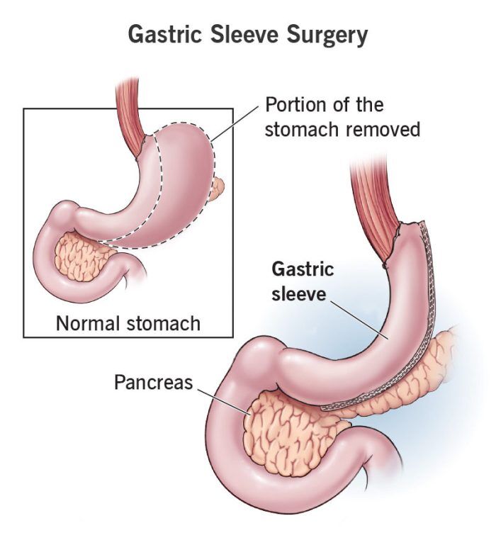 Sleeve Gastrectomy in Punjab | Dr Amit Garg CODSILS