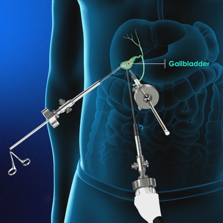 #1 Gall Bladder Surgeon in Mohali | Dr Amit Garg – CODSILS